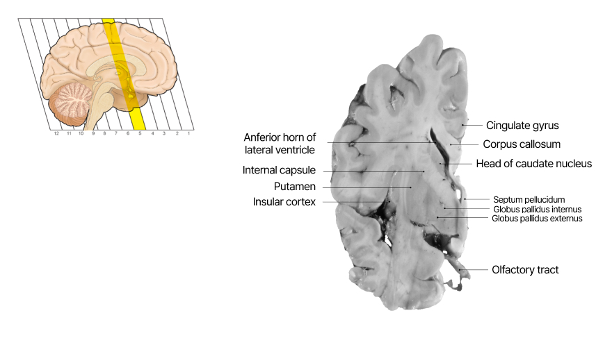 관상면(Coronal Section) - 뇌구조 | 뇌클러스터전문포털(K-Brain Net)