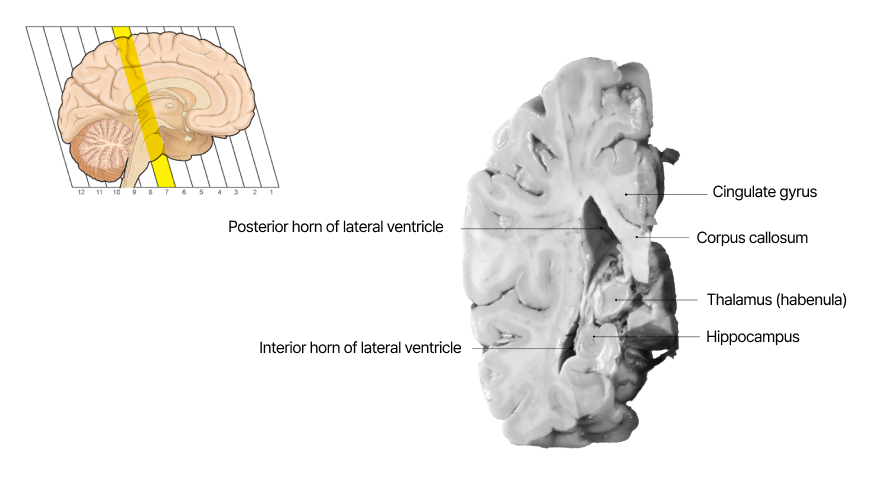 관상면(Coronal Section) - 뇌구조 | 뇌클러스터전문포털(K-Brain Net)