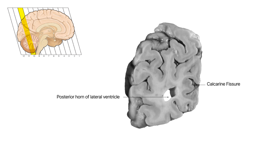 관상면(Coronal Section) - 뇌구조 | 뇌클러스터전문포털(K-Brain Net)